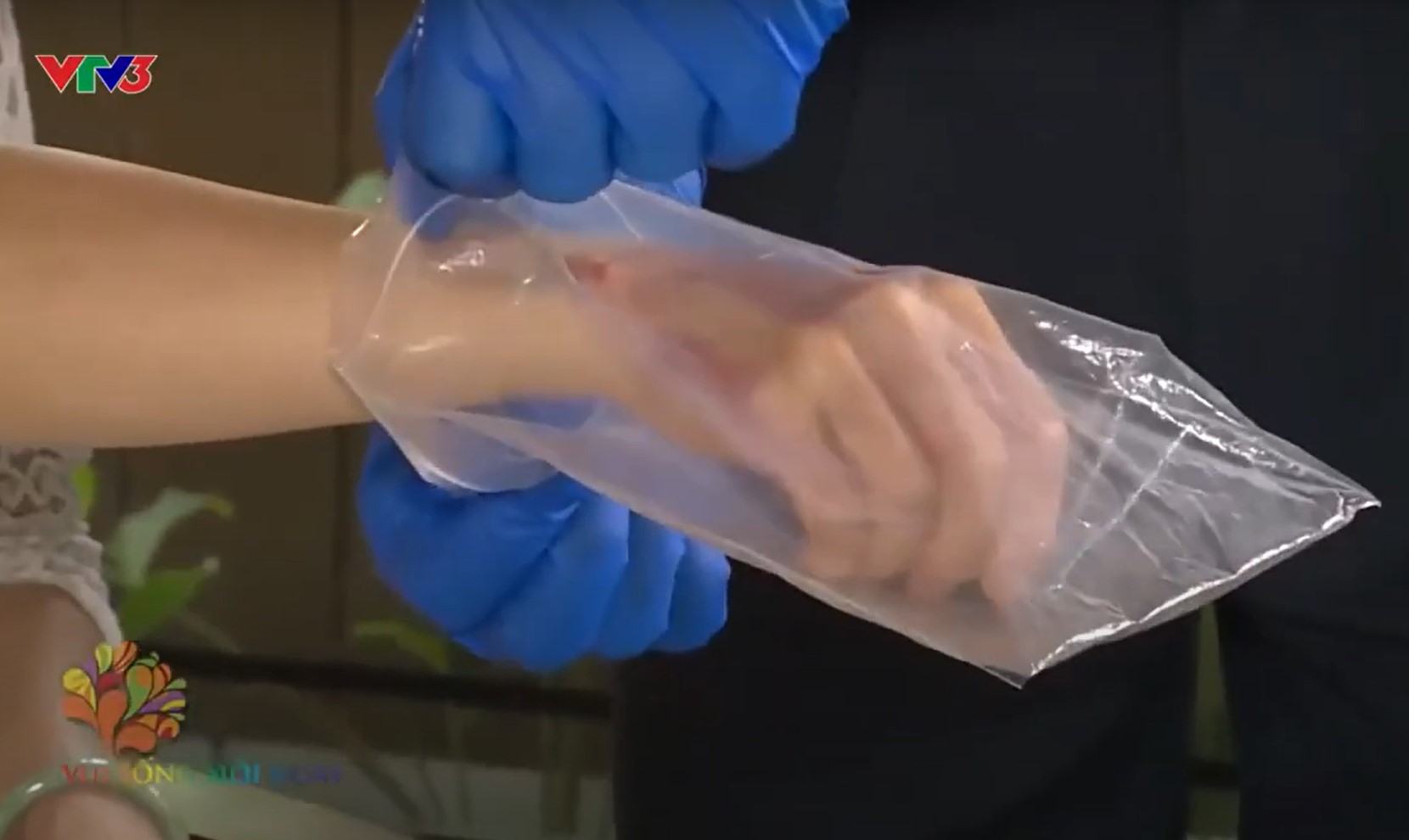 First aid for burns (burns) - Kỹ năng Sinh tồn SSVN