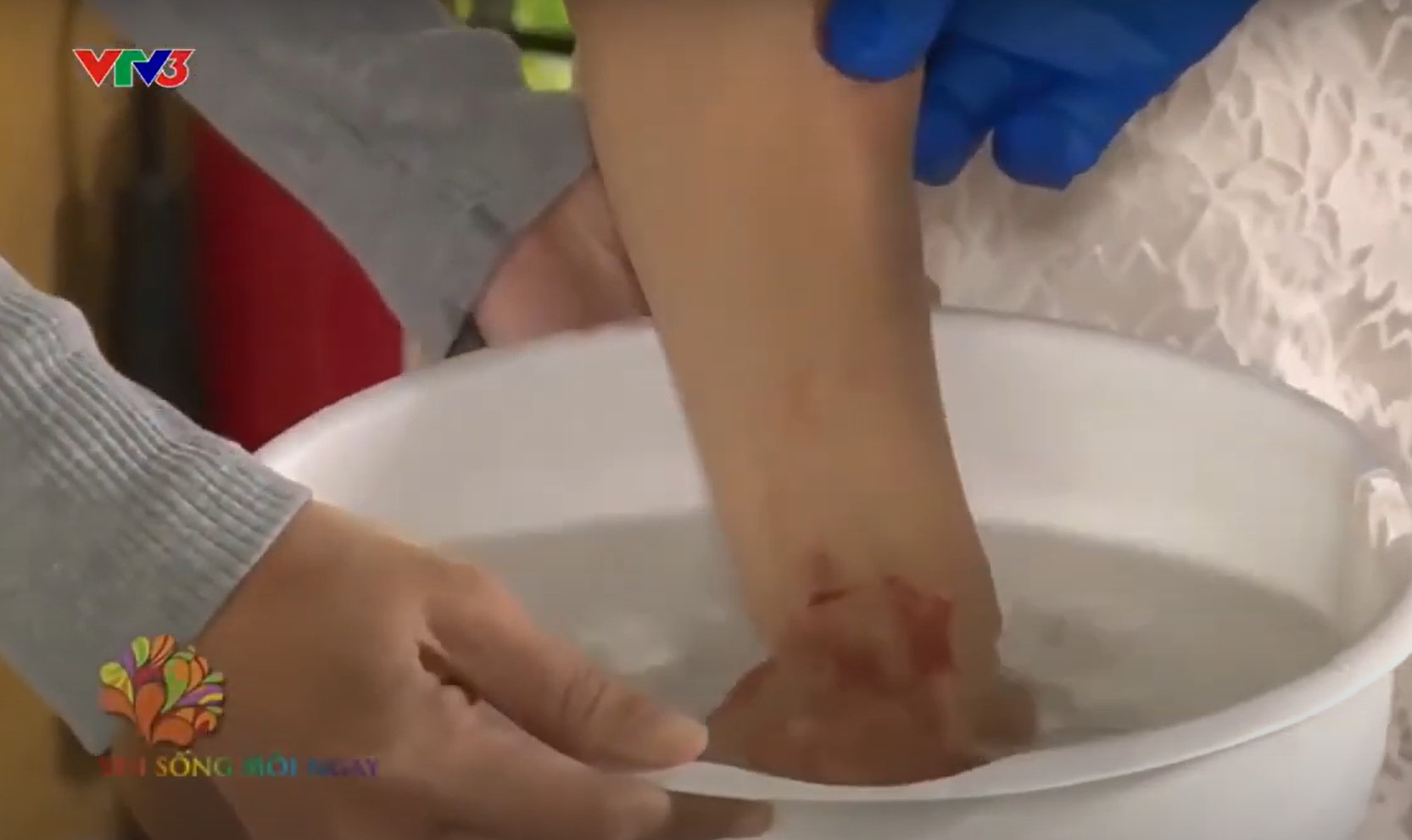 First aid for burns (burns) - Kỹ năng Sinh tồn SSVN